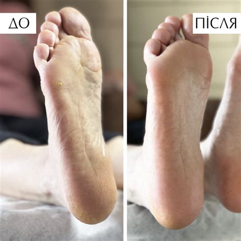 Кератолітик для видалення мозолів та натоптишів КЕРА Подоліквід Pnb 100 мл купити в Києві ціна