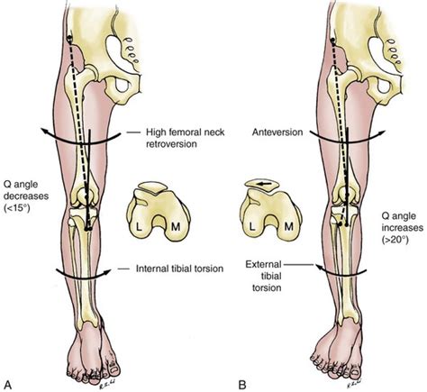 External Tibial Torsion