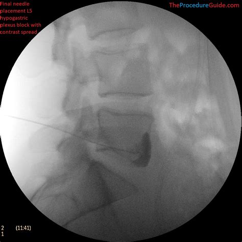 Hypogastric Plexus Block Technique And Overview The Procedure Guide