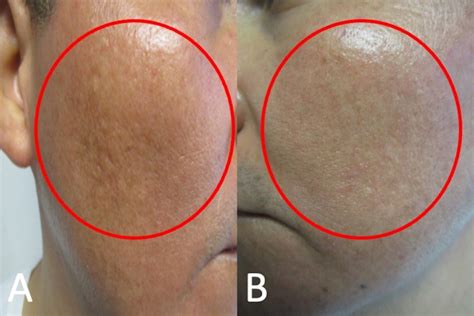 Doxycycline Associated Hyperpigmentation A Case Report And Literature