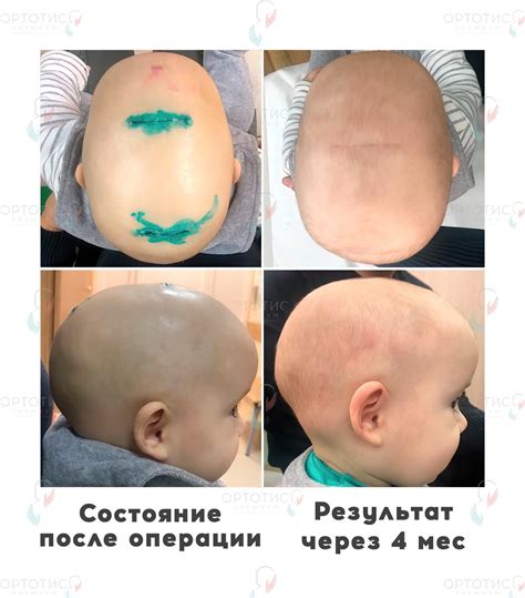 Результаты деформация головы фото 2 Ортотис Премиум