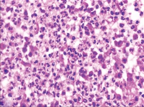 Blastomycosis Like Pyoderma Novel Use Of Potassium Iodide Indian