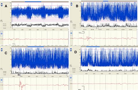 Differences Between Term And Preterm Aeeg In Health And Disease Panel Download Scientific
