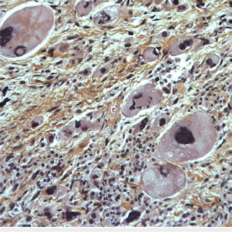 Undifferentiated Pleomorphic Sarcoma High Power Field [hpf] × 400 Download Scientific