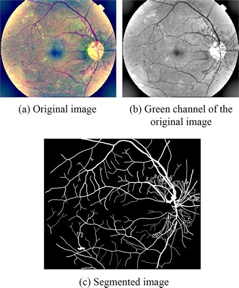 An Effective And Comprehensible Method To Detect And Evaluate Retinal