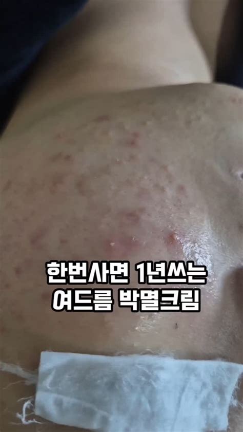 노랗게 익은 화농성 여드름은 만지면 아프고 놔두면 보기싫고 어쩌다 압출하거나 세수하다 터질 경우가 있습니다 노란 농이 빠지고 난 자리는 공간이 텅 비게 됩니다