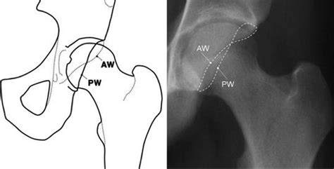 Acetabular Retroversion Musculoskeletal Key