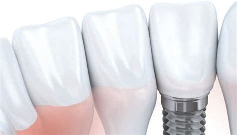 Preventing Peri Implantitis Dimensions Of Dental Hygiene