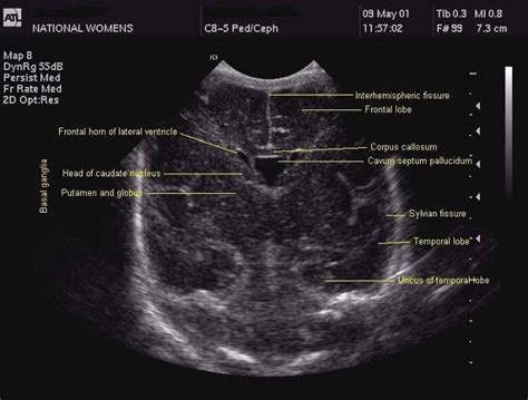 Cranial Ultrasound State Of The Art Cranial Ultrasound Imaging In