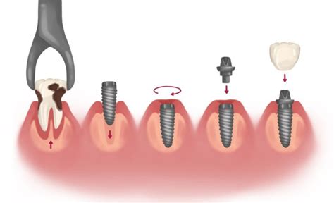 Dental Implant Immediately After Extraction Dental Implants Dental