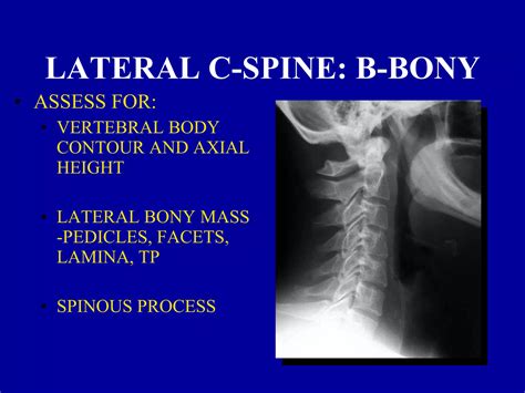 Cervical Spine Injury C Spine Clearing The Cervical Spine Ppt