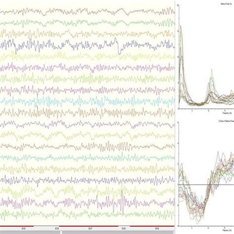 Spectrogram Displaying Intrusion Of Emg Artifact Into Eeg Download
