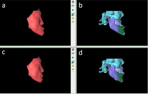 Software Generated Textured Facial Soft Tissue Prediction According To Download Scientific
