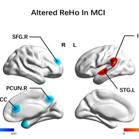 Figure Brain Regions Showing Altered Alfffalff Values In Patients With