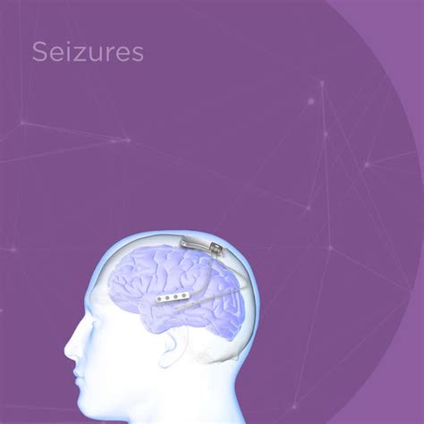 Neuropace On Linkedin The Rns System Is A Epilepsy Treatment Device