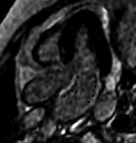 Cardiac Magnetic Resonance Imaging Demonstrating Left Atrial Fibrosis Download Scientific