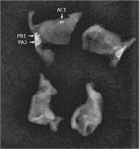 Lateral View Of X Ray Of A 17 Year Old Female Showing Calcification In Download Scientific