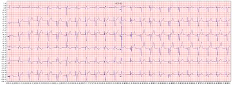 Examples Of Normal Functioning Artifcial Pacemaker Pace Ecg Library