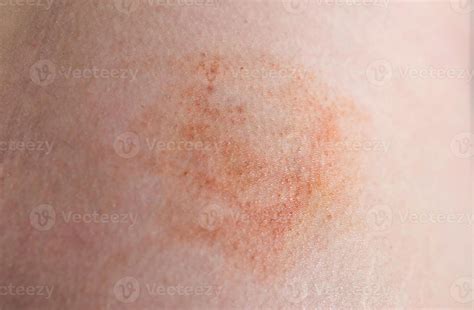 Bruise And Subcutaneous Lump On The Patient S Skin After Injections Post Injection Infiltrates
