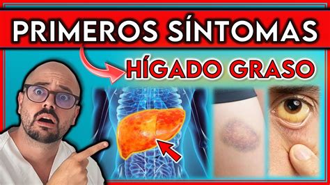 Grasa En El Higado Consecuencias Lmxf