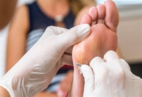 The Best Ways To Get Rid Of Calluses Artofit