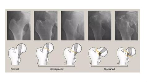 Proximal Femur Fractures Pptx