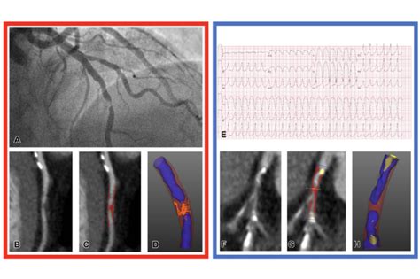 Distinguishing Type 1 From Type 2 Myocardial Infarction Translational Cardiovascular Research