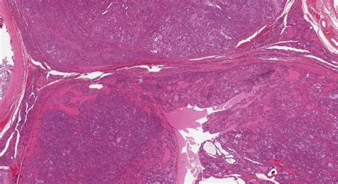 Oncocytic Carcinoma Of The Thyroid Gland Atlas Of Pathology
