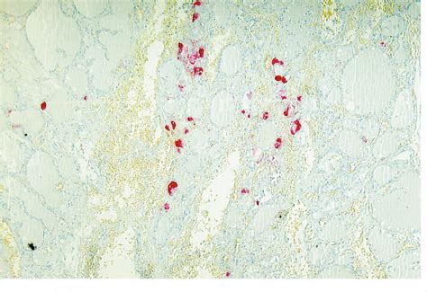 Figure 1 From Development Of The Parafollicular Cells In Recurrent Goiter Semantic Scholar