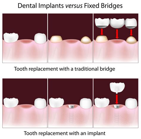What Happens If I Dont Replace A Tooth Orange Ca Dr Christopher J Fotinos