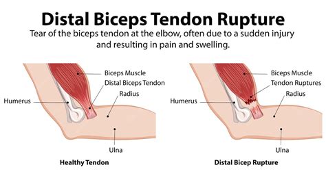 Free Vector Distal Biceps Tendon Rupture Illustration