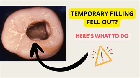 What To Do If Your Temporary Filling Falls Out After A Root Canal