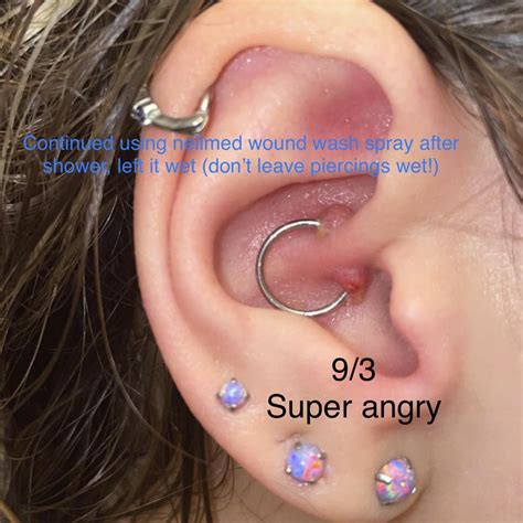 Piercing Bump On Back Of Conch Rpiercing