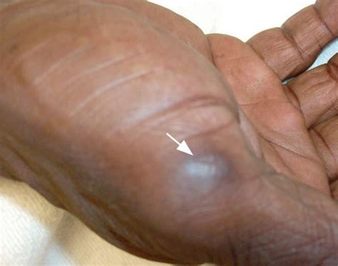 Osler Nodes Endocarditis