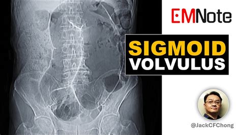 How Do You Treat A Sigmoid Volvulus