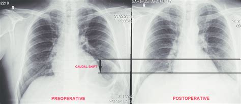 Radiological Comparison Of Pre And Postoperative Posteroanterior Chest Download Scientific