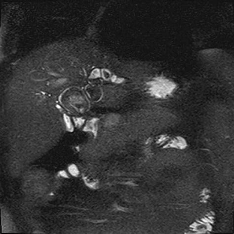 Intraoperative View Of Hepaticojejunostomy To Be Revised Download Scientific Diagram