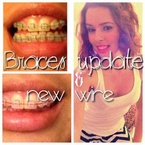 New Braces Update Video Check It Out Youtube Youtu Be Rzfyv Wsfes Youtube Braces