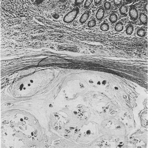 Appendix With Fibrosis And Calcification In Wall In Presence Ofpurulent Download Scientific