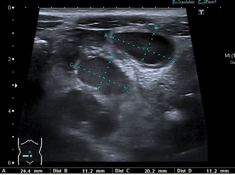 Appendix Detection Object Detection Dataset And Pre Trained Model By Agri