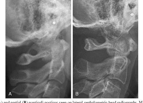 Figure 2 From Prevalence And Morphologic Features Of Ponticulus Posticus In Koreans Analysis Of