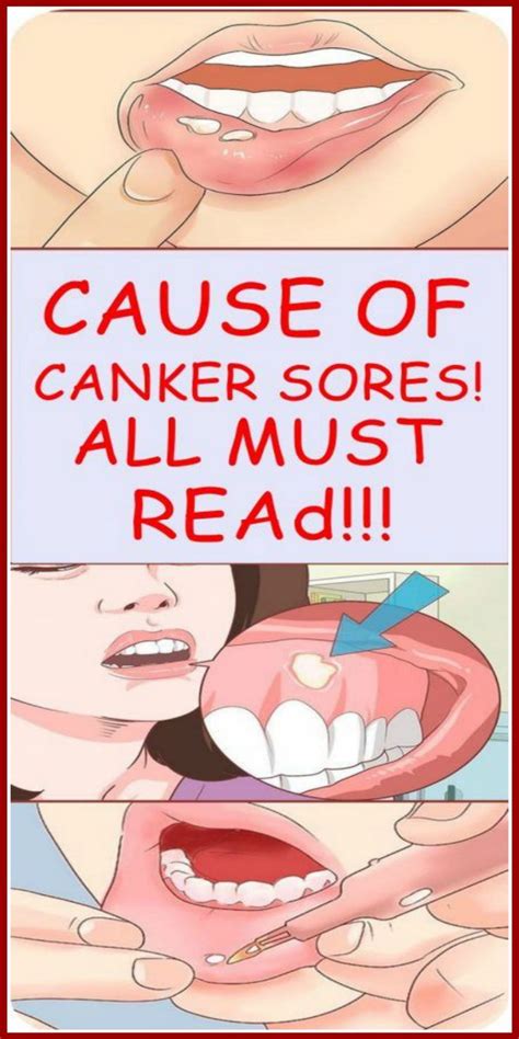 Understanding Canker Sores Causes Types And Managemen Vrogue Co