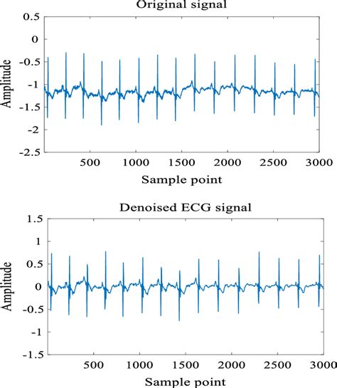 Denoising Of Ecg Signals Of Myocarditis Patients Download Scientific Diagram