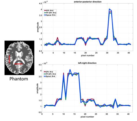Line Plots From The Digital Brain Phantom Images In The Phase And Download Scientific Diagram