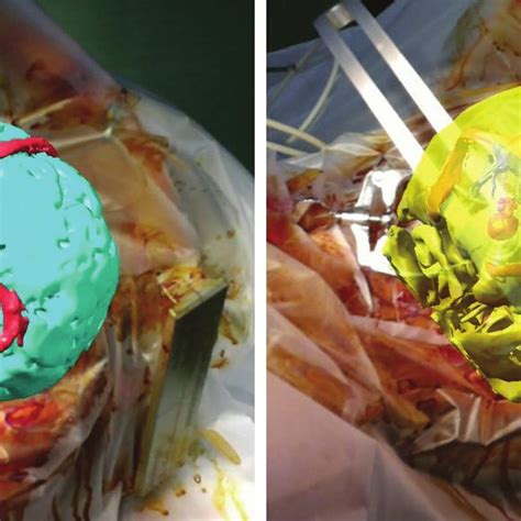 The Case Of Right Cerebellar Tumor Augmented Reality Visualization Download Scientific Diagram