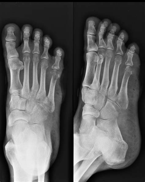 Ankle Fracture And Dislocation Buyxraysonline