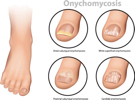 White Superficial Onychomycosis