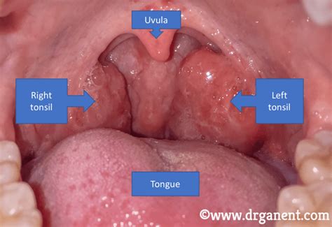Mouth Tonsil Stones At Anitra Bourne Blog
