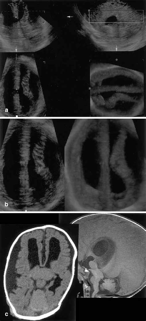 A C The 3d Us Of Chronic Subdural Effusion After Subdural Haemorrhage Download Scientific