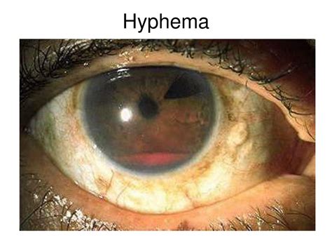 Ppt Eye Emergencies Powerpoint Presentation Free Download Id 2399733